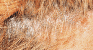 Qué es la foliculitis: causas, factores y prevención - IMD